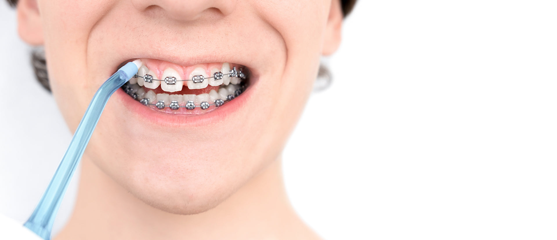 Ortopedia dentofacial y ortodoncia, claves para una sonrisa alineada ...